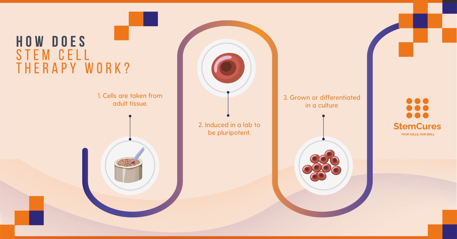 Differences Between Prolotherapy Stem Cell Therapy And Prp Stemcures